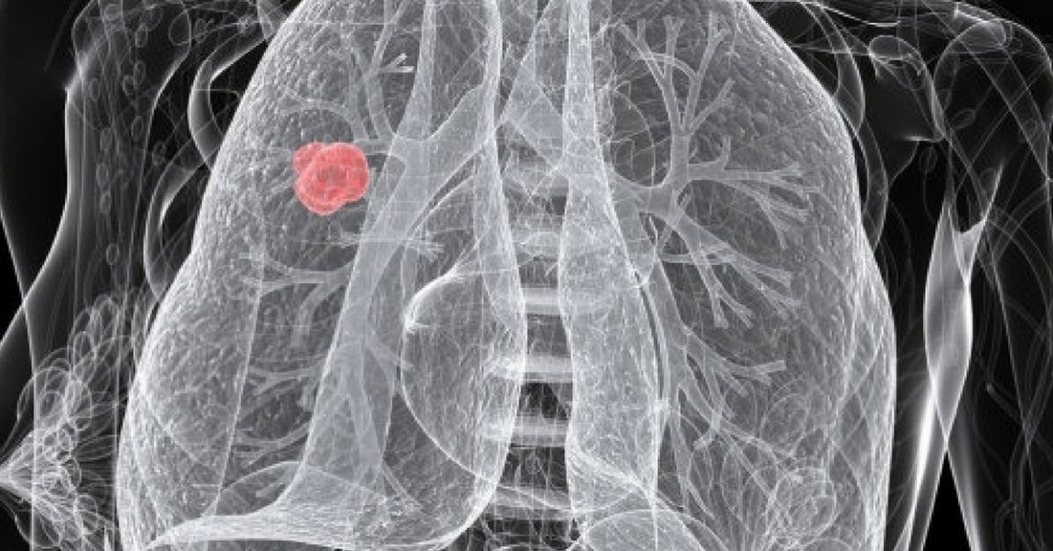 Lung Cancer- 6 Common Signs That You May Be at Risk